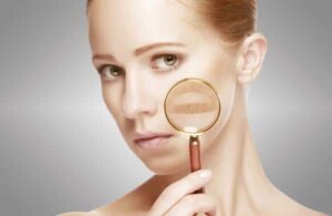 Hipercromia: o que é e seus vários tipos (Melasma, Lentigo, etc.)