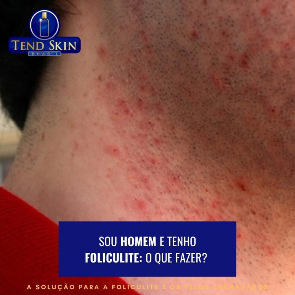 Foliculite - Blog TendSkin