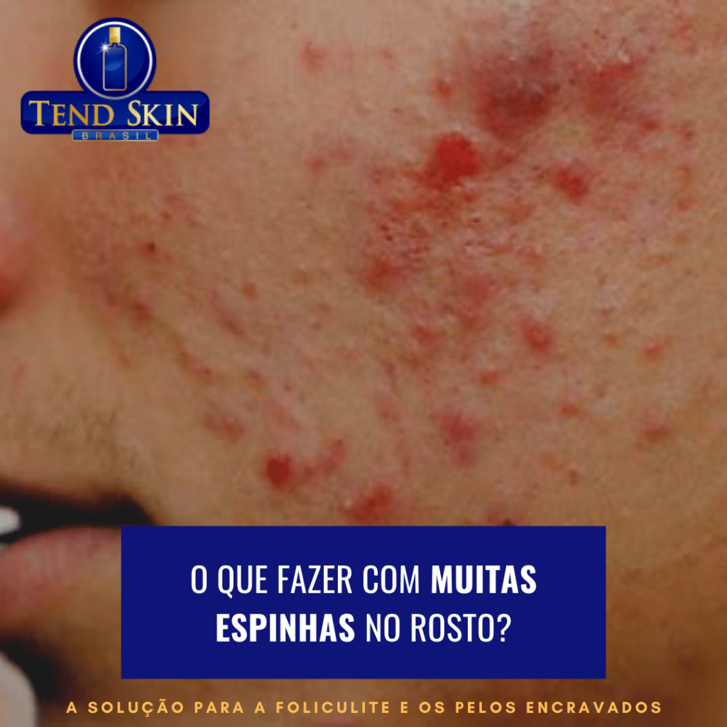 O que fazer com muitas espinhas no rosto? - Blog TendSkin