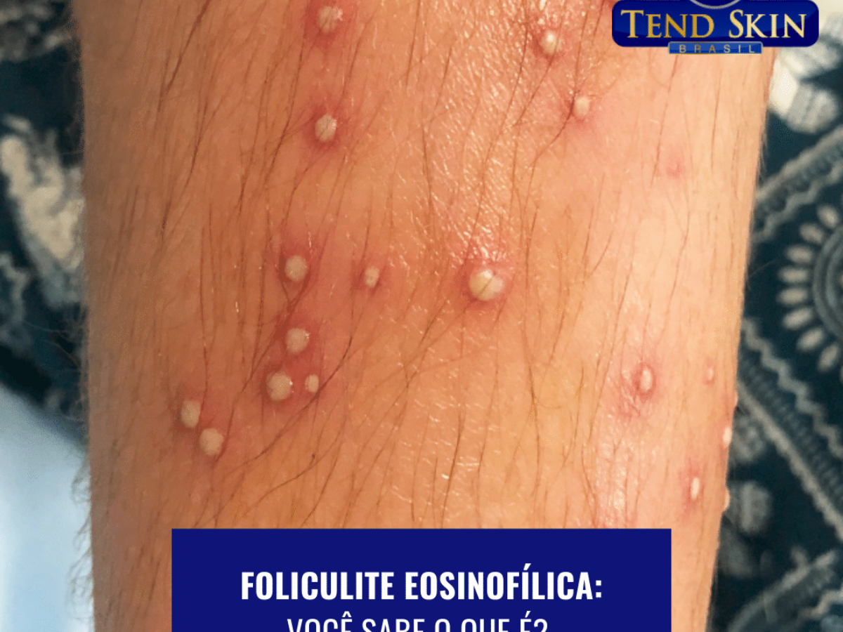 Foliculite Pustulosa Eosinofilica Em Bebes