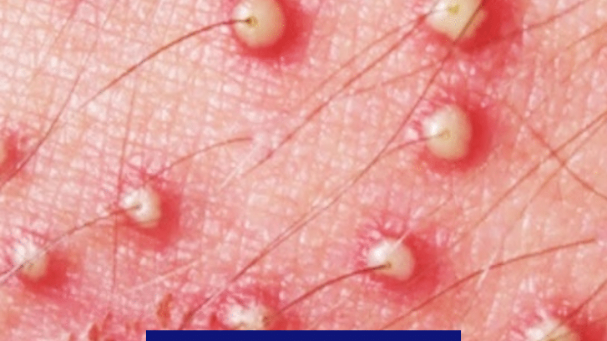 Foliculite Escrotal Tratamento De Pele, Uso Externo. Cura Os Seguintes