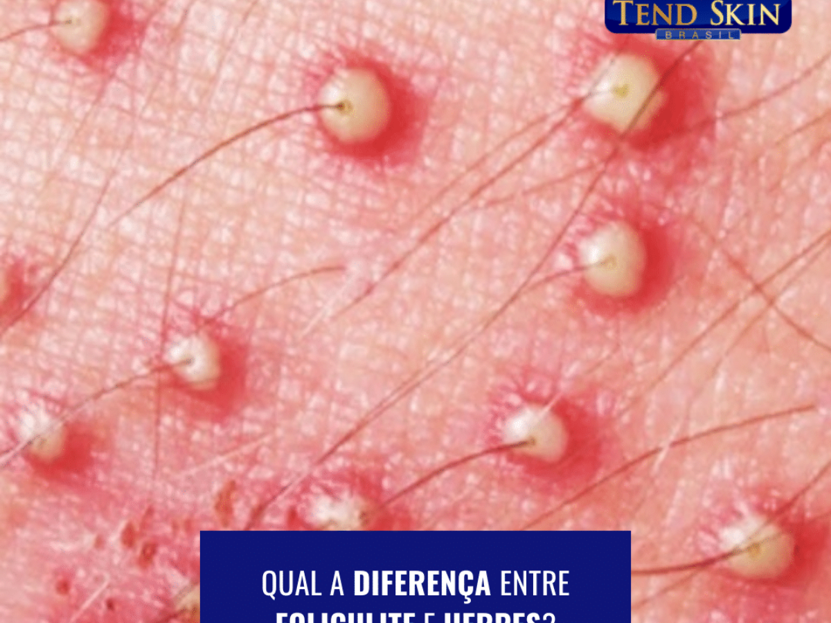 Herpes Genital Feminina