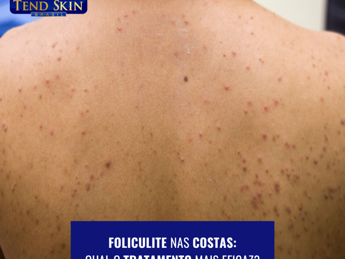 Foliculite Viral Foliculite Capilar: Saiba O Que Causa E Como Curar