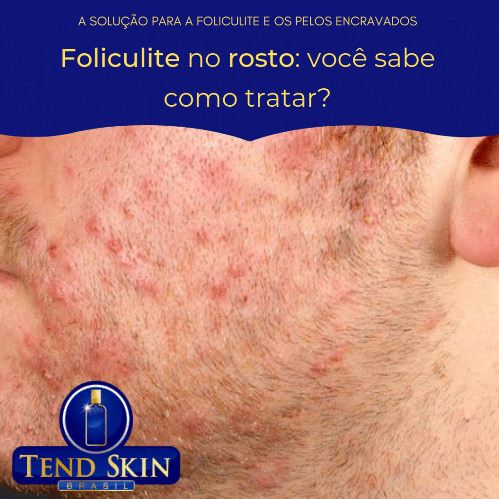 Foliculite No Rosto: Você Sabe Como Tratar?