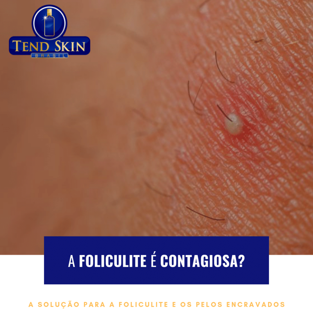 A Foliculite é Contagiosa?