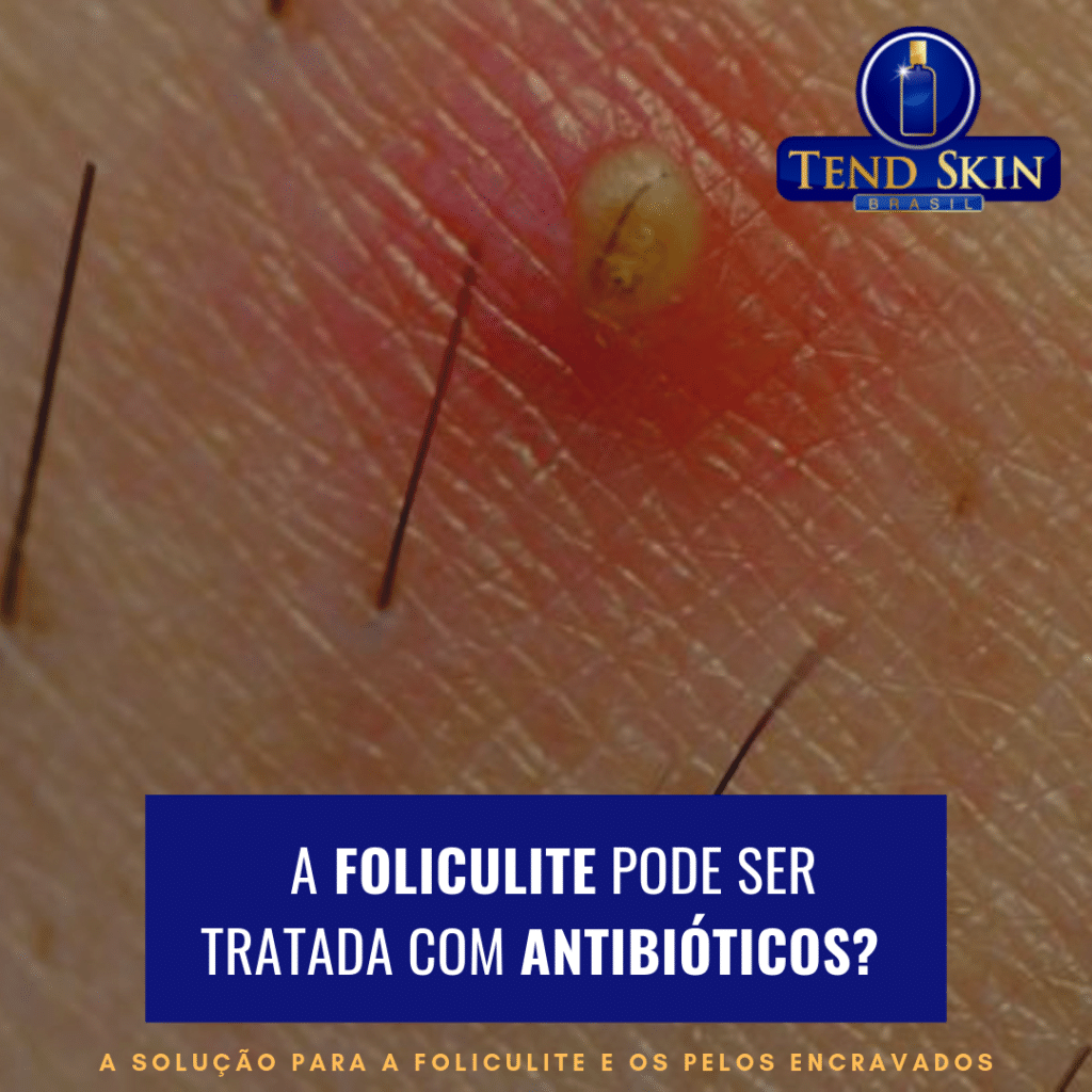 A Foliculite Pode Ser Tratada Com Antibióticos?