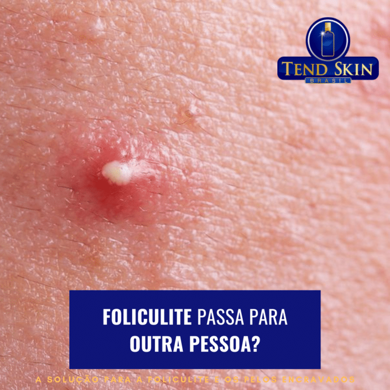 Foliculite Passa Para Outra Pessoa?