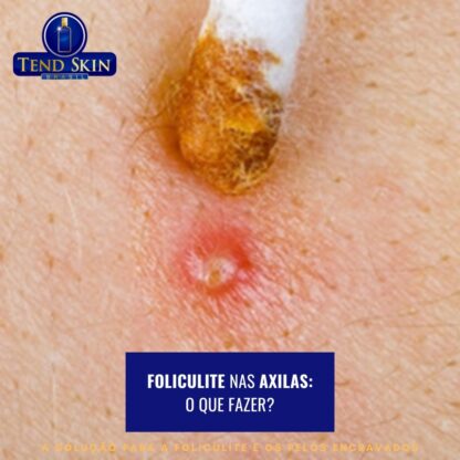 Foliculite Na Axila? Dr. Ensina 5 Opções De Tratamento!