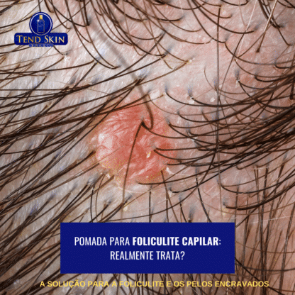 Remédio Para Foliculite Capilar: Conheça Os 3 Principais!