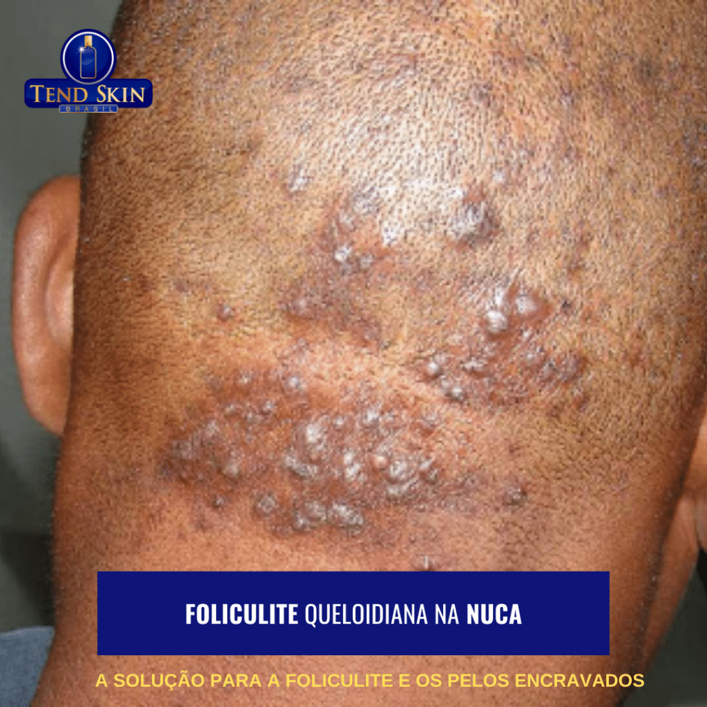 Foliculite Queloidiana | Dr. Foliculite Ensina A Trata-La!